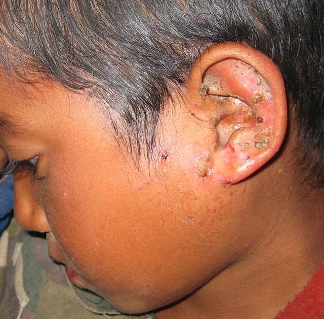 Infection, pinna - EarAidNepal