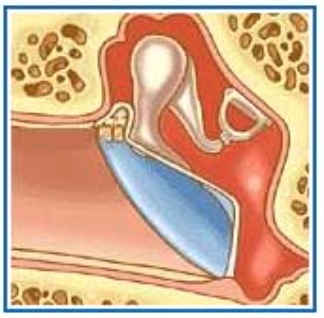 Cholesteatoma Diagrams - EarAidNepal